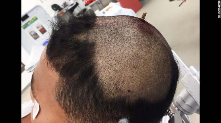 Boy Escapes Death After Screw Punctures Skull – SurvivalKit.com